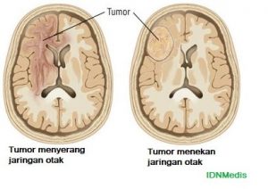 Kanker Otak A-Z – Penyebab – Gejala dan Pengobatan - IDN Medis