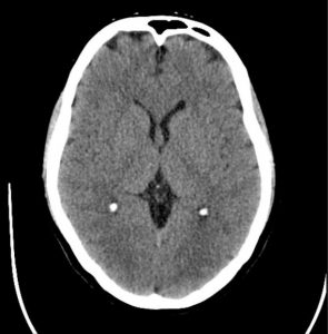 CT Scan Kepala: Fungsi, Prosedur dan Efek Samping - IDN Medis
