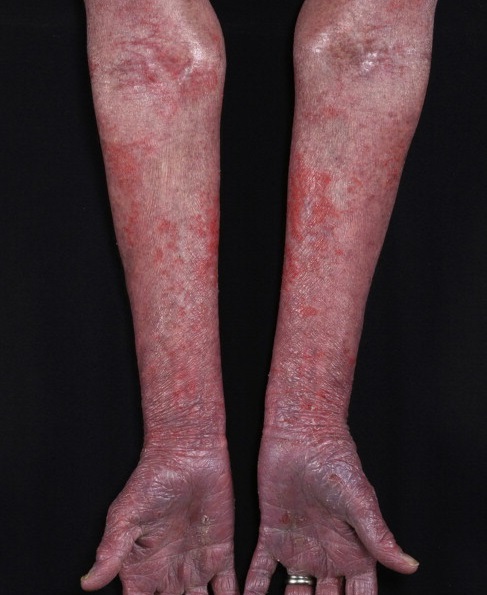 Sindrom Sezary: Penyebab – Gejala dan Cara Mengobati - IDN Medis